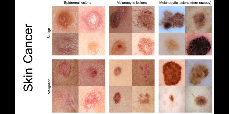 Αφαίρεση σπίλων και ογκιδίων δέρματος - Ιωάννης Δρίτσας - Δερματολόγος